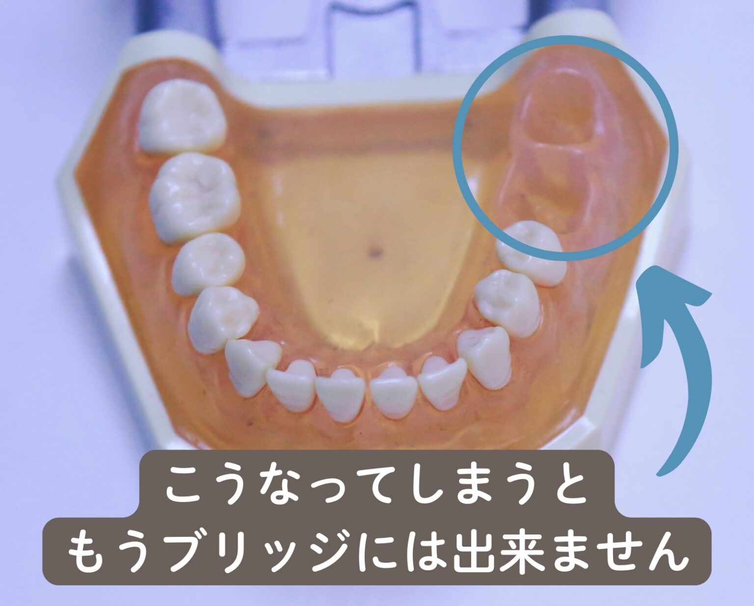徹底解説！歯を失った時の治療法 〜ブリッジ編〜 メリット・デメリットから考える – 谷町六丁目しちご歯科・矯正歯科